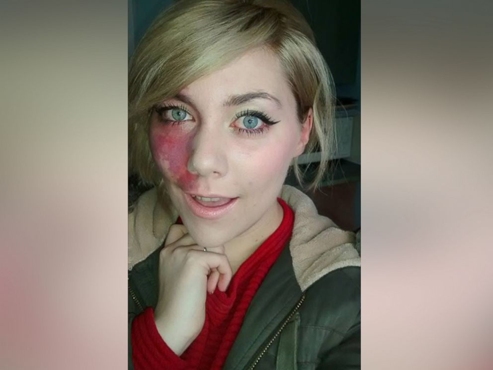 Woman Shares Birthmark Photos After Being Asked To Appear On