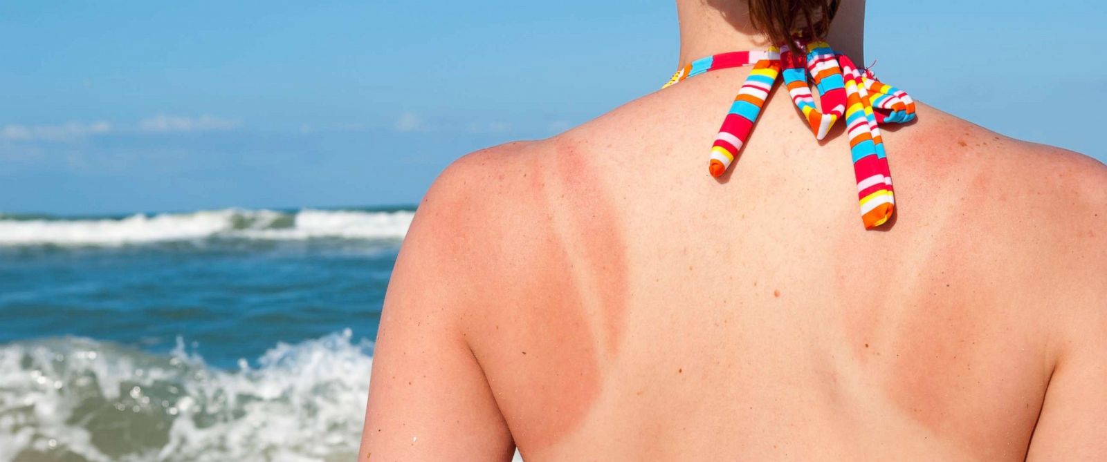 Diy Remedies To Help Soothe Summer Sunburns Abc News